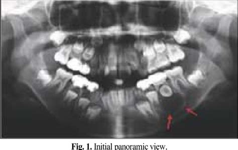 Figure 1 From The Formocresol Pulpotomy Semantic Scholar