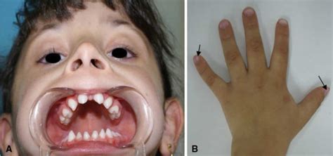 Hypohidrotic Ectodermal Dysplasia Causes Symptoms Diagnosis And Treatment