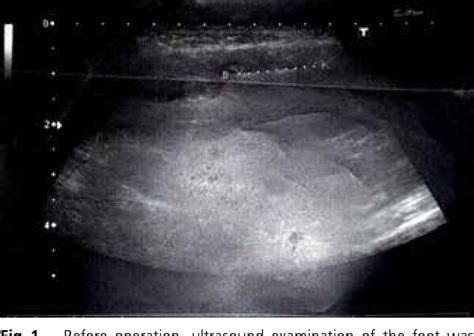 Figure 1 From Migration Of A Toothpick Along The Flexor Tendon Sheath