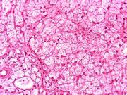 Glycogen Storage Diseases Libre Pathology