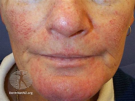 Understanding Rosacea TheGoodSkinPlace