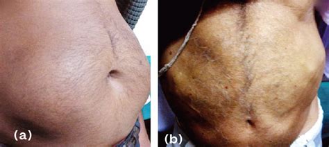 What Are The Insulin Injection Site Complications