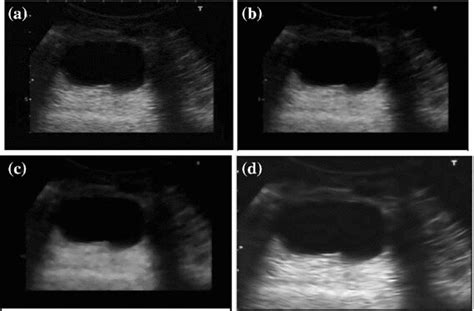 Prostate Cyst Ultrasound Image A Original Image B Homomorphic Wavelet Download Scientific