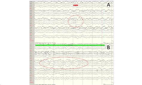 Electroencephalogram Of Case 2 Prior To Antiepileptic Therapy A Left Download Scientific
