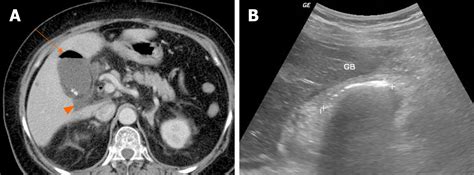Benign Gallbladder Diseases Imaging Techniques And Tips For