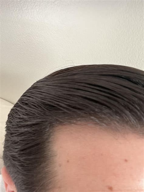 8 Months Minoxodil Finasteride And Microneedling I Think I Am Starting To See Progress