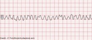 Ventricular Fibrillation V Fib ECG EKG Nursing Review