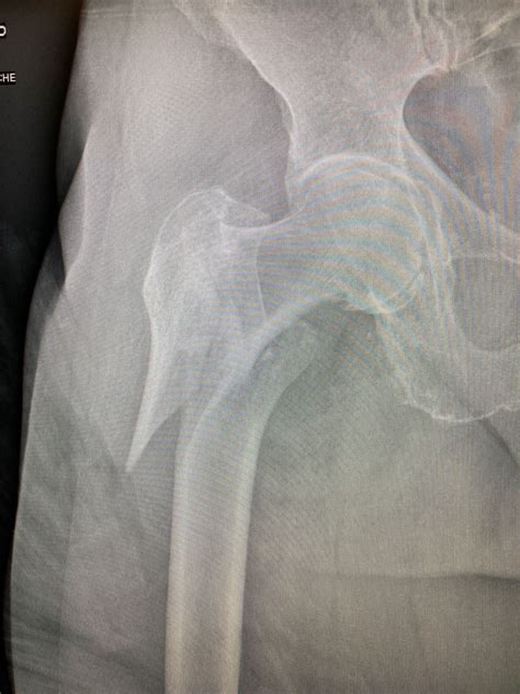 📍reverse Fracture In An Elderly Women As Usual Traction Table Is Not