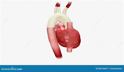The Enlarged Portion Of The Aortic Arch Is Replaced With A Synthetic Graft Stock Illustration