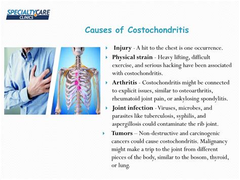 Ppt Costochondritis Powerpoint Presentation Free Download Id11475742