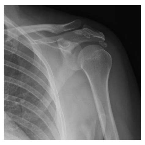 Arthroscopic View Into The Subacromial Space Showing A Large Download Scientific Diagram