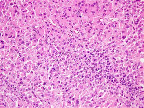 Pathology Outlines Epithelioid Sarcoma