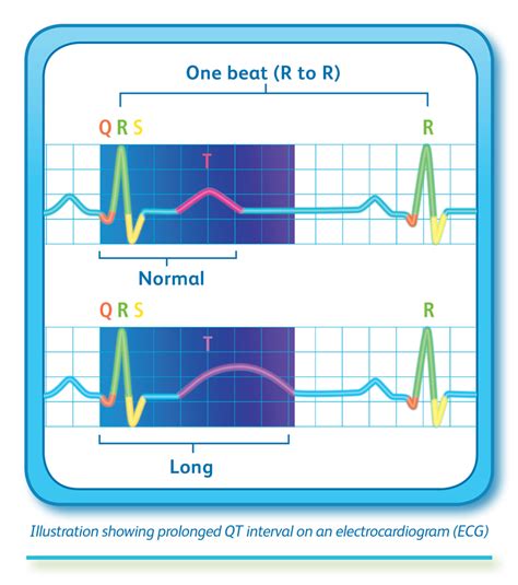 Physical Activity BMI And Smoking History Affect QT Interval Duration In Cardiac Patients