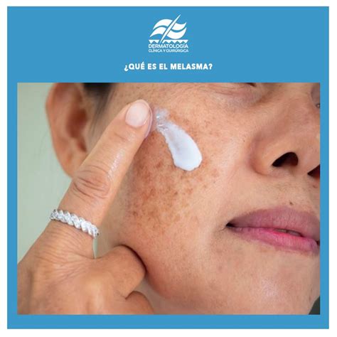 El Melasma Es Un Trastorno Cutáneo Dr José Luis Ramírez Facebook