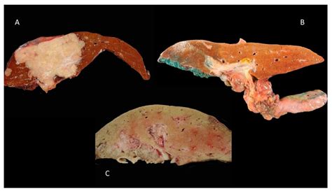 Pathology Of Cholangiocarcinomas