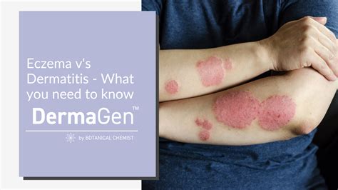 Eczema Vs Dermatitis What You Need To Know Dermagen By Botanical