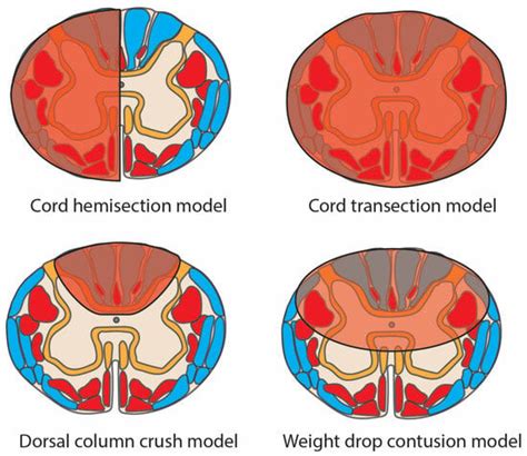 Contusion Cerebral Anisocoria Without Extraocular Muscle Impairment