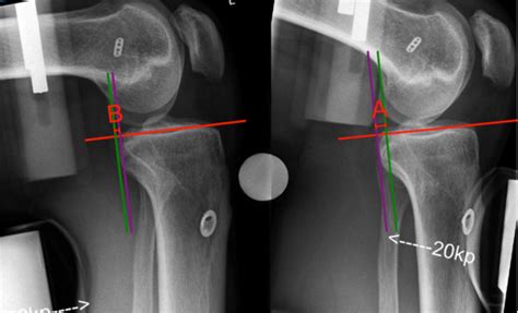 Posterior Tibial Displacement A And Anterior Tibial Displacement B Download Scientific