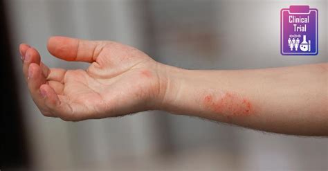 Comparison Between The Effectiveness Of Erythromycin Single Dose Clarithromycin And Topical