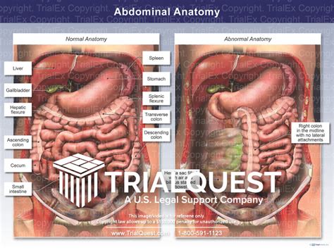Normal And Abnormal Abdominal Anatomy Trial Exhibits Inc