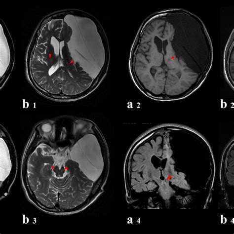 Left Arachnoid Cyst After Abdominal Drainage The Left Frontal