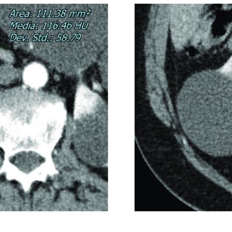 Abdominal Cect Of 66 Year Old Male Patient With A 16 Mm Nodular Lesion Download Scientific