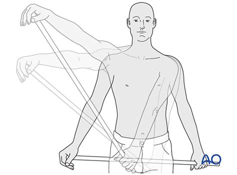 Nonoperative Treatment Of Scapular Fractures For Body And Processes