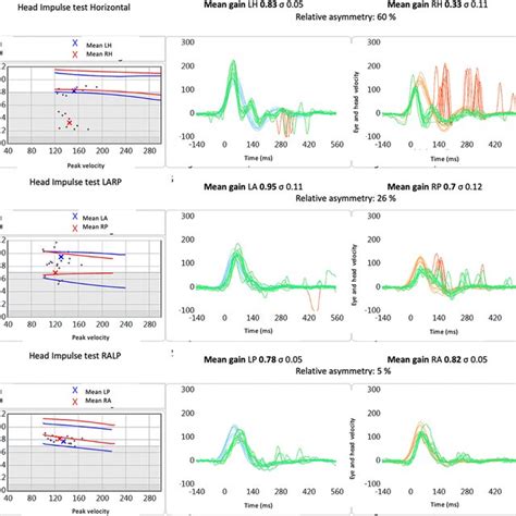 Vhit Examination Results Before Treatment Rh Right Horizontal Rp