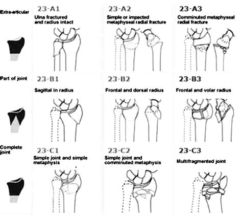 Ao Classification Of Distal Radius Fractures My Xxx Hot Girl
