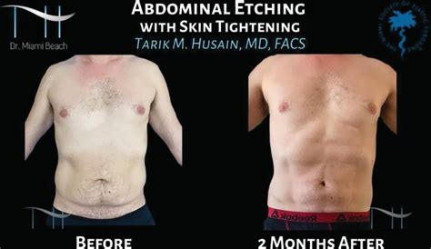 Abdominal Etching For Male Bodybuilders Springer Nature Link