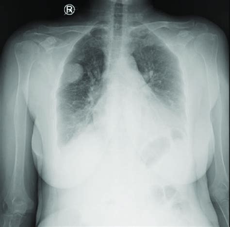 Chest X Ray Pa View Showing Right Upper Lung Opacity With Download Scientific Diagram