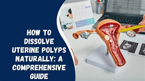 How To Dissolve Uterine Polyps Naturally A Comprehensive Guide English Saga