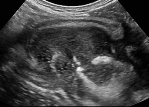 Abdomen And Retroperitoneum 1 5 Appendix Case 1 5 6 Post Appendectomy Ultrasound Cases