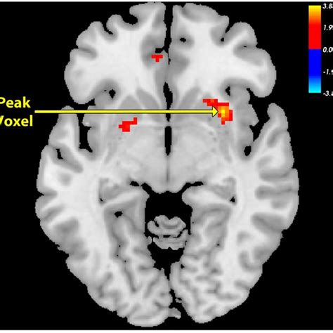 Nucleus Accumbens Seed Bilateral Nucleus Accumbens Seed Used In Download Scientific Diagram