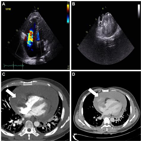 Figure 1 From Rapidly Progressive Metastatic Angiosarcoma Of The Heart