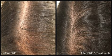 Prp Before And Afters