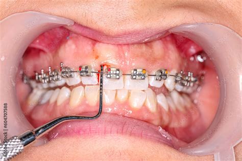 Dental Orthodontics Patient With Colored Bracket And Elastic Ligatures