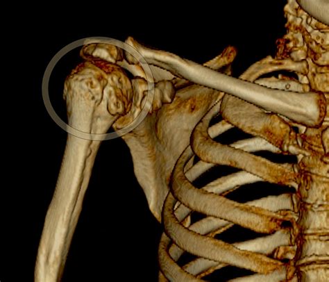 Clavicle Fractures Allman And Neer Classification Journal Of