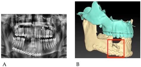 Mandibular Fracture X Ray Mandibular Fracture X Ray