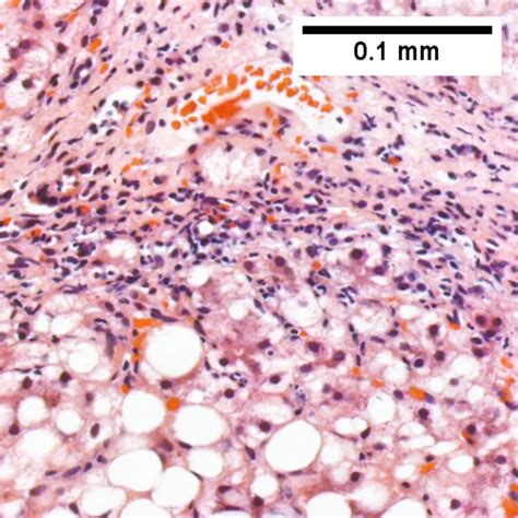 Hepatitis C Libre Pathology