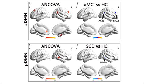 Brain Regions Exhibiting Significant Differences In Dynamic Download Scientific Diagram