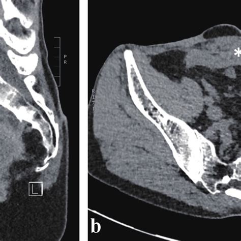Abdominal Ct Scan Without Contrast Sagittal A And Axial B Views