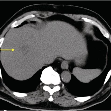 Ct Scan Without Contrast‐enhancement On The 3rd Hospital Day Showing