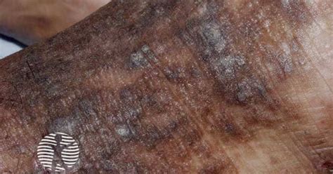 Lichen Simplex Image