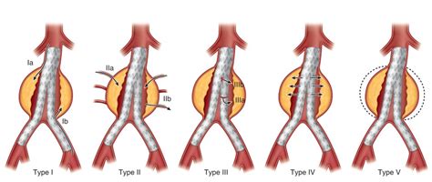 Endoleaks Thoracic Key