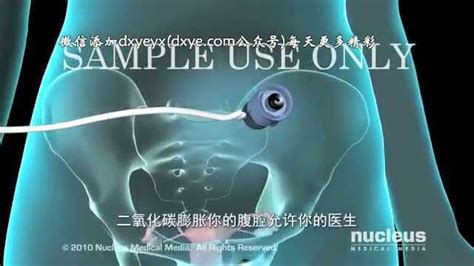 输卵管结扎术中文字幕动画演示 腾讯视频