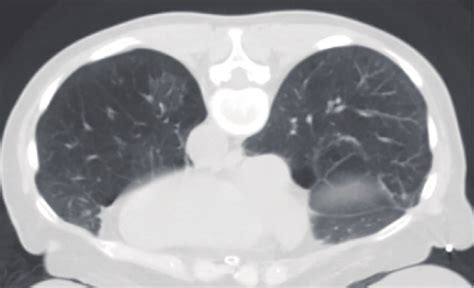 Left Lower Lobe Apical Segment Pure Ground Glass Nodule 31 Mm T1a Download Scientific Diagram