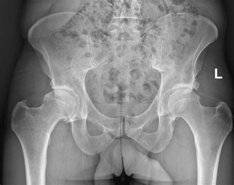 Consent A Tale Of Two Hips As An Sem Consultant Part Of My Remit Is To Help Patients Avoid