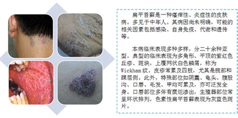皮肤苔藓图片 皮肤苔藓 苔藓图片 大山谷图库
