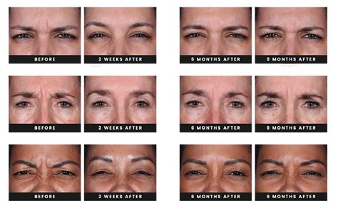Daxxify Long Acting Botox Botox Honolulul